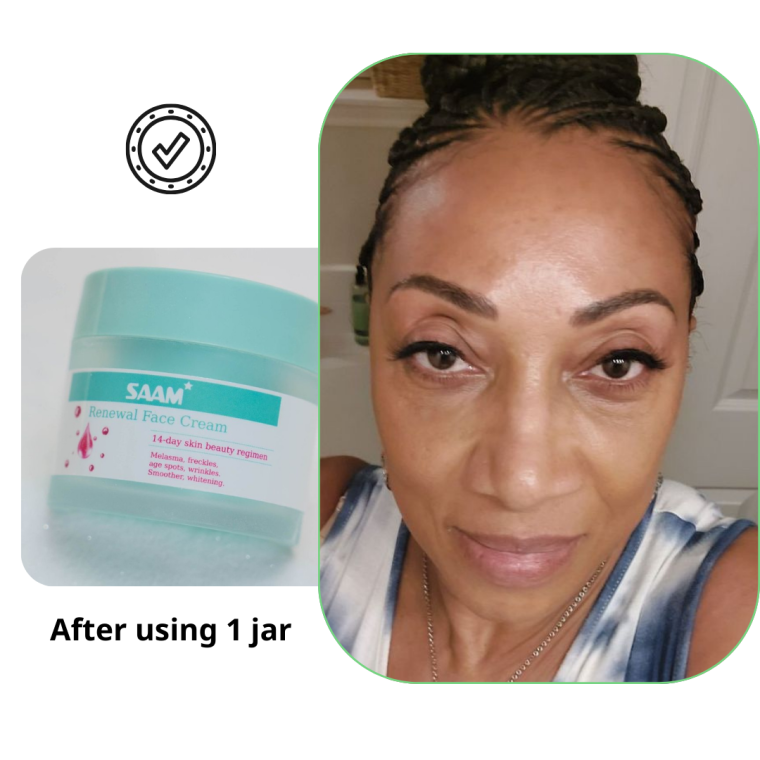 REMOVE MELASMA, FRECKLES, DARK SKIN | SAAM RENEWAL FACECREAM – Saam ...