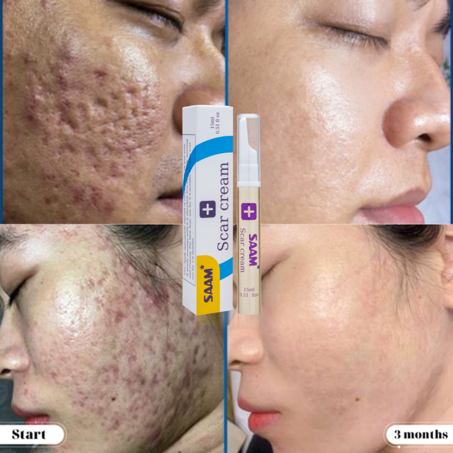 REMOVE PITTED SCARS, KELOID SCARS, DARK & UNEVEN SCARS | SAAM SCAR ...