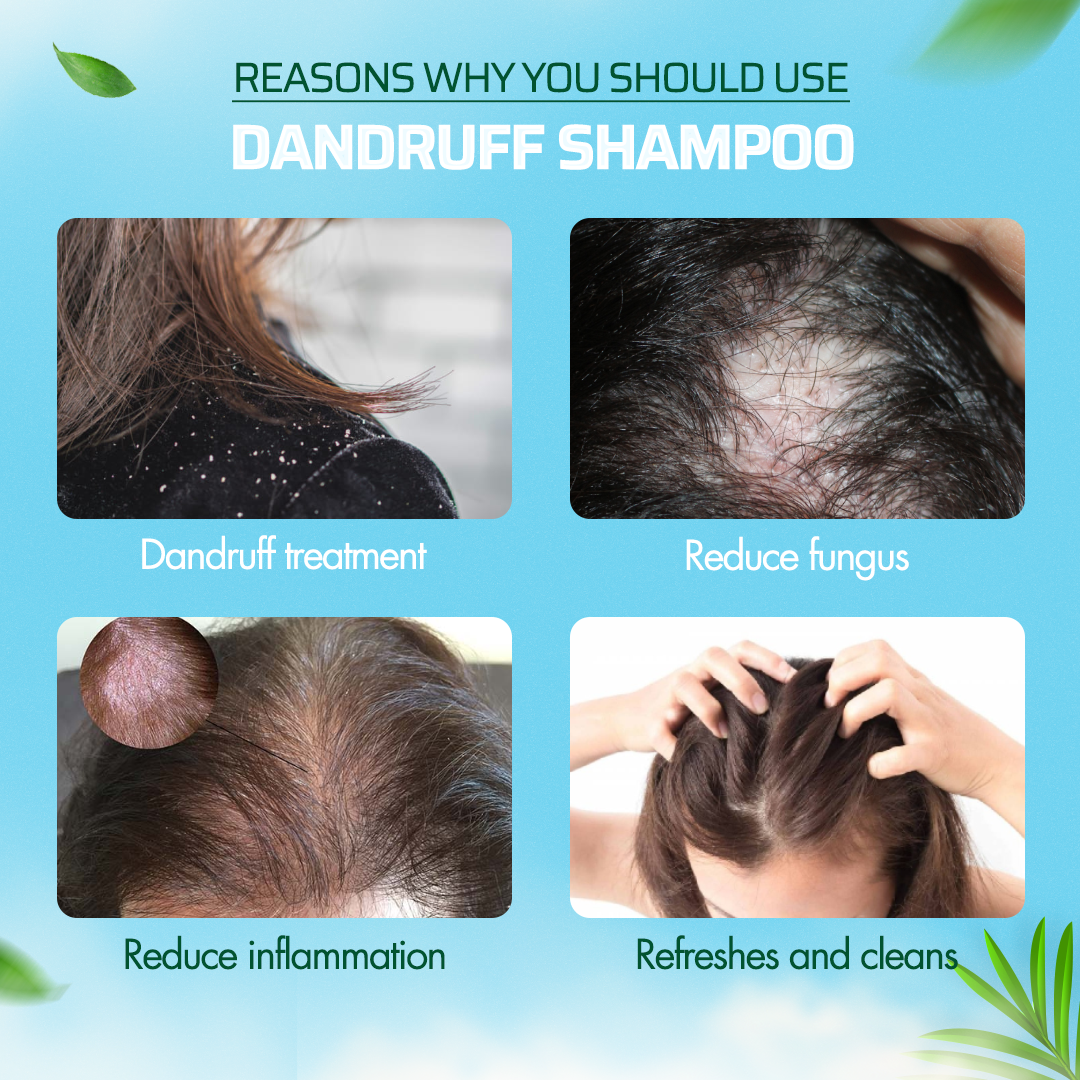 NO MORE WORRIES ABOUT DANDRUFF WITH SAAM DANDRUFF SHAMPOO 150ML - saam ...