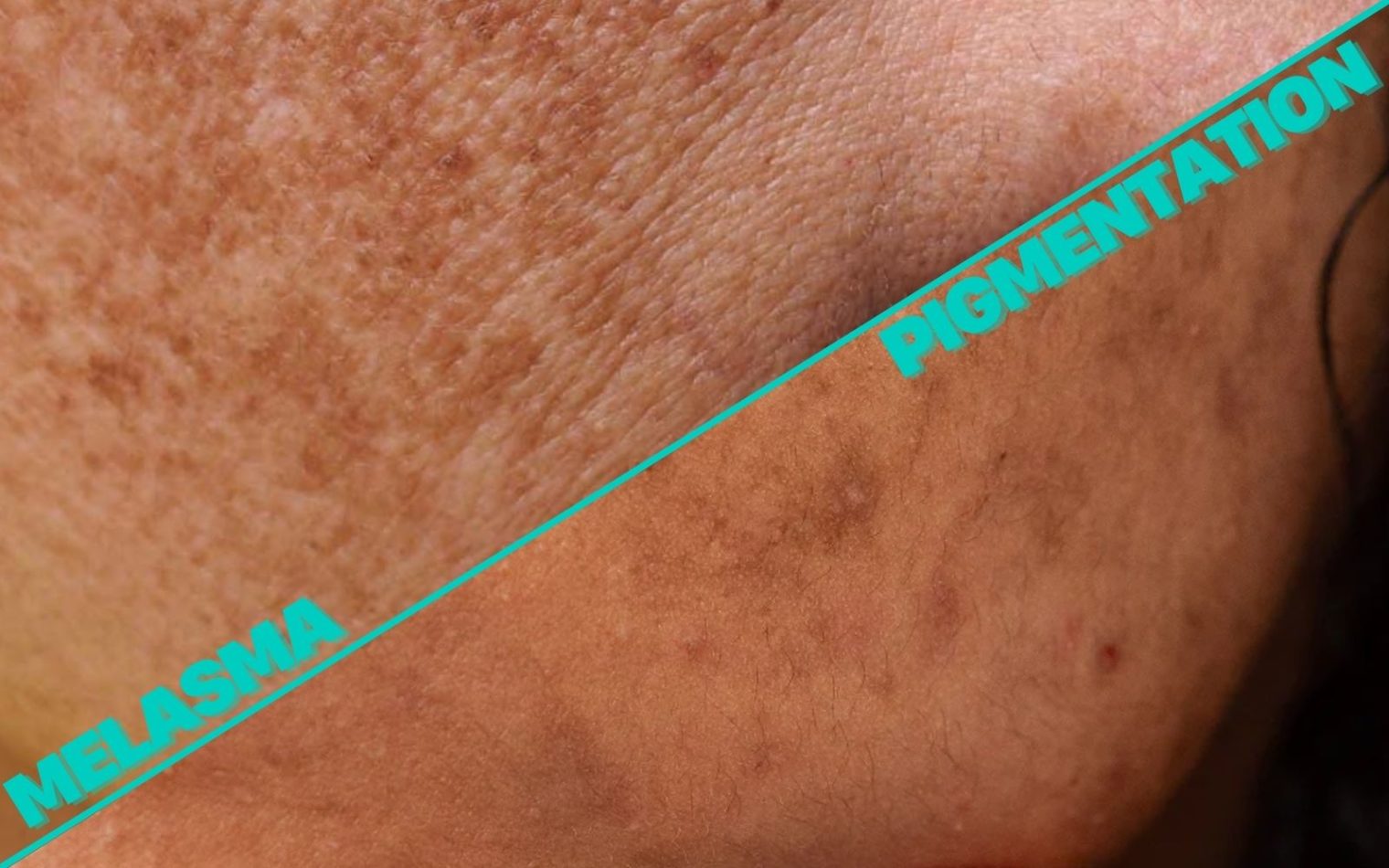 Melasma and Pigmentation: Know The Difference