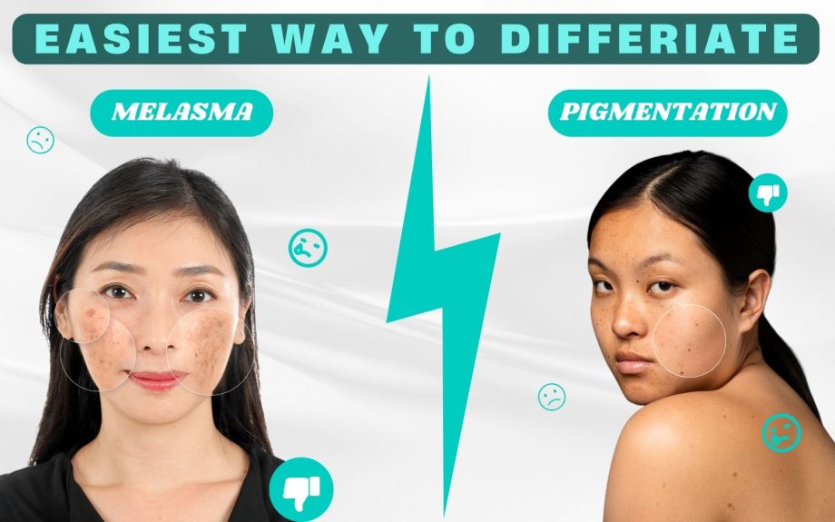 Melasma and Pigmentation: Know The Difference