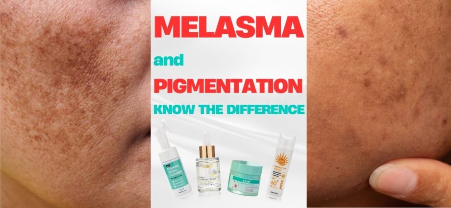 Melasma and Pigmentation: Know The Difference